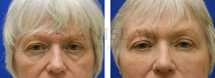 Malar Bags Before and After Photos Connecticut