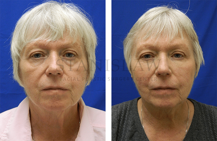 Malar Bags Before and After Photos Connecticut