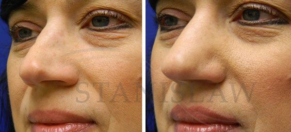 Non Surgical Nose Job Connecticut | Liquid Rhinoplasty Near Me