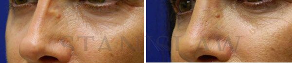 Non Surgical Nose Job Connecticut | Liquid Rhinoplasty Near Me