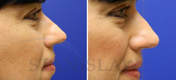 Non Surgical Nose Job Connecticut | Liquid Rhinoplasty Near Me