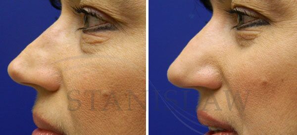 Non Surgical Nose Job Connecticut | Liquid Rhinoplasty Near Me